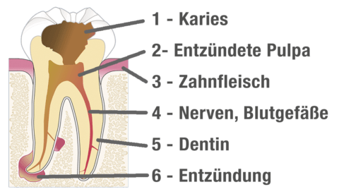 Wurzelbehandlung - Zähne vor dem Verlust retten